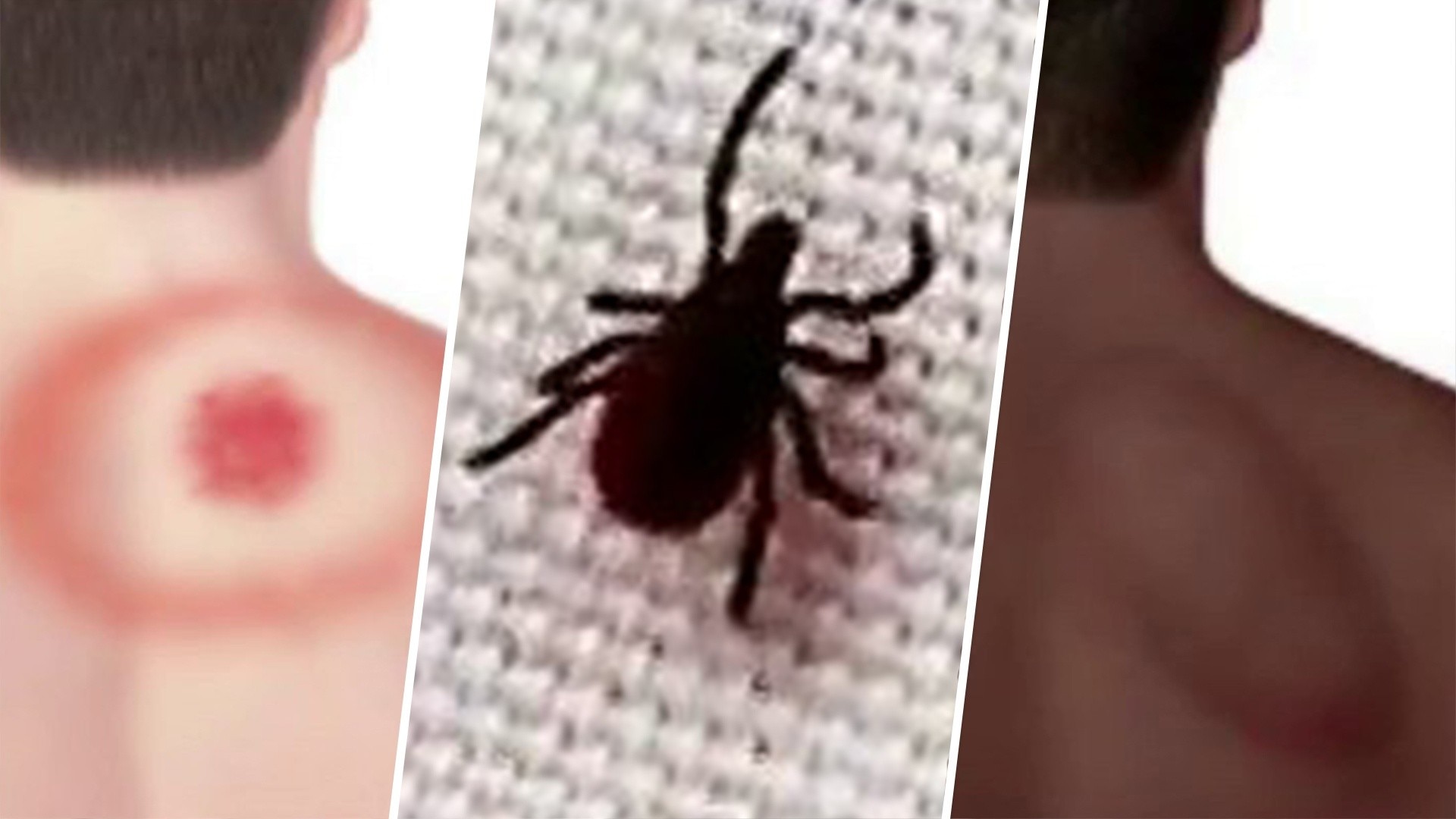 Watch TODAY Excerpt: Important tips to protect you from ticks and the ...