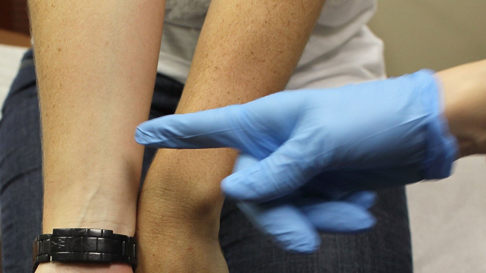 Watch TODAY Excerpt: How is melanoma different from other skin cancers ...